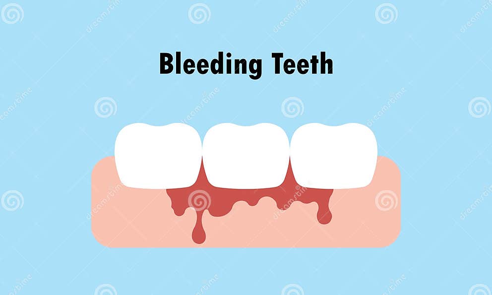 Bleeding Tooth while Brush stock vector. Illustration of banner - 277325105