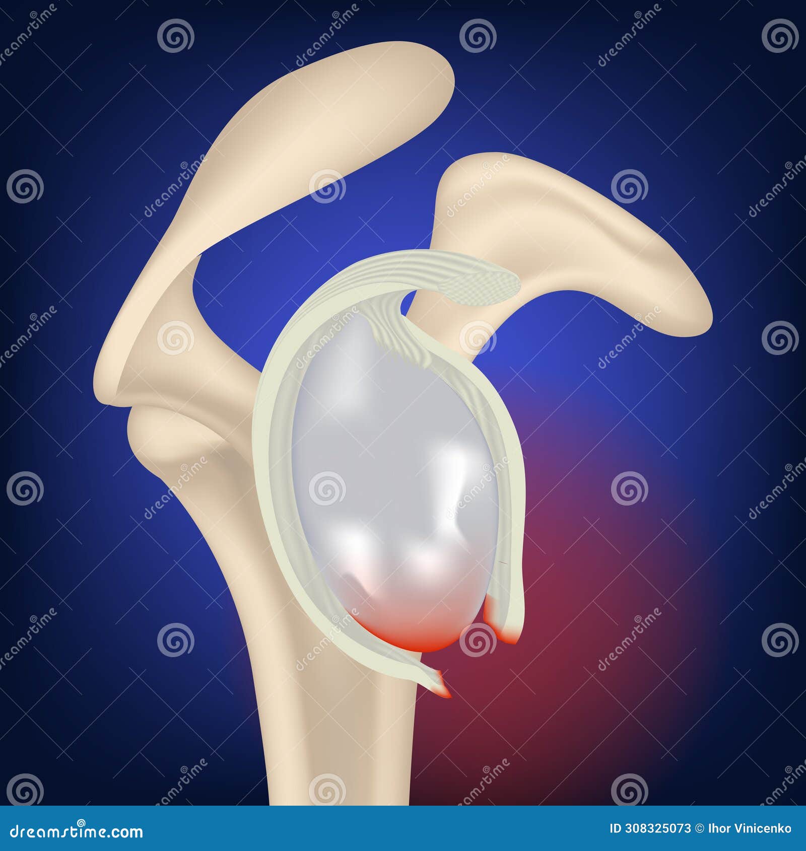 Rupture Of The Clavicular Cavity. Rendering Of A Collarbone On A Blue ...