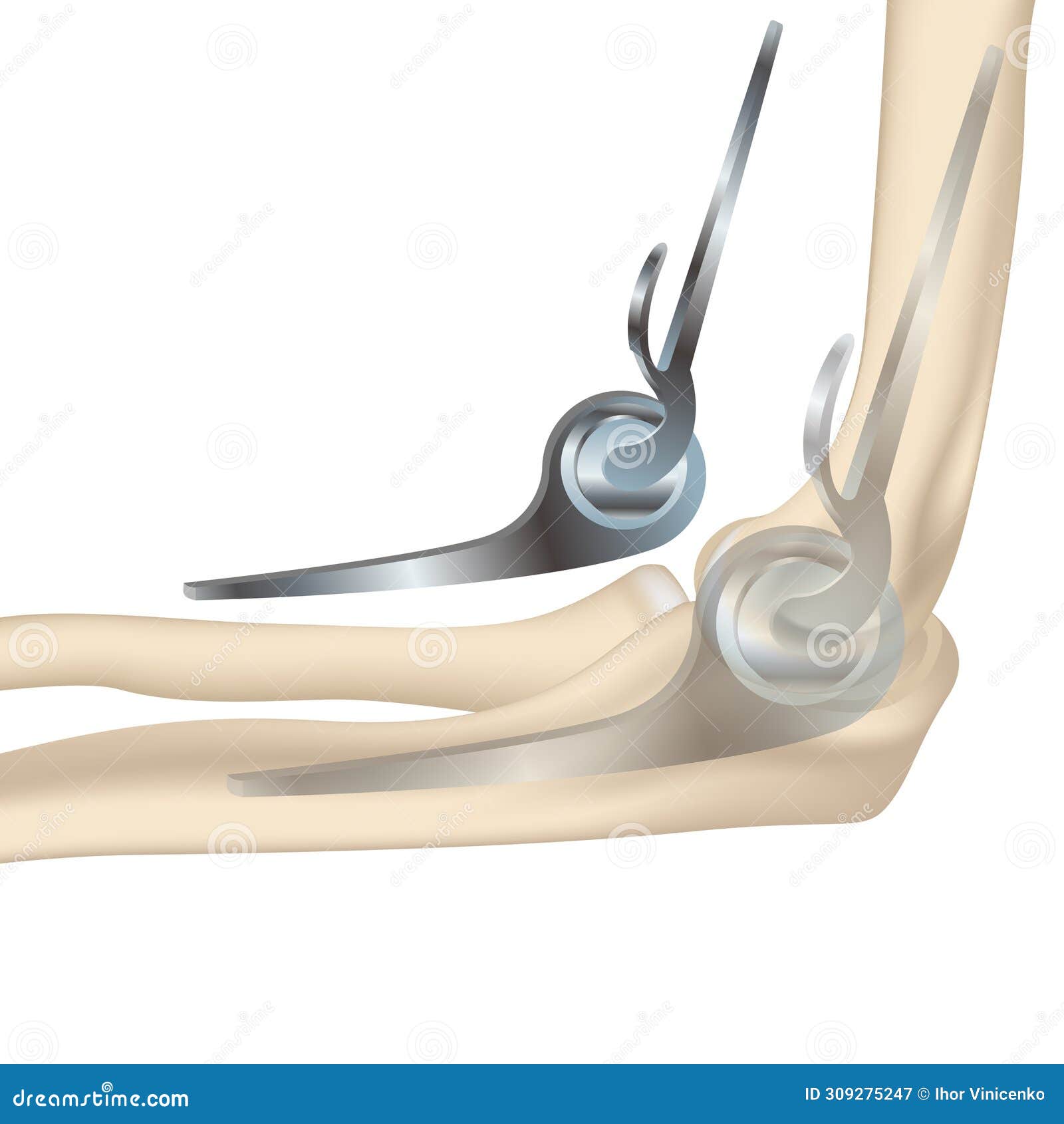 Endoprosthetics Of The Elbow Joint, Humeral Head. Cartoon Vector ...