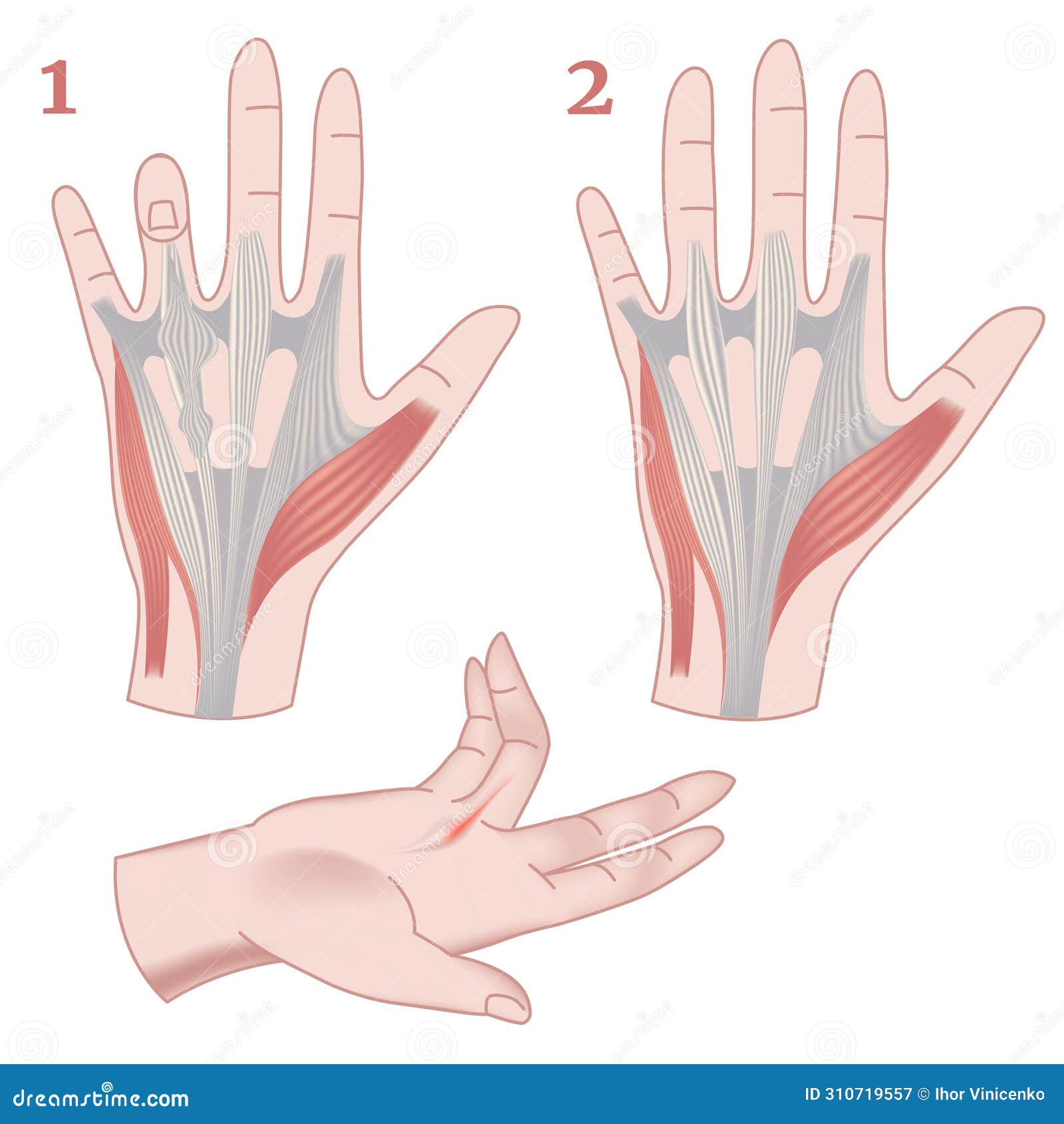 Dupuytren S Contracture. Medical Poster with Disease Infographics Stock ...