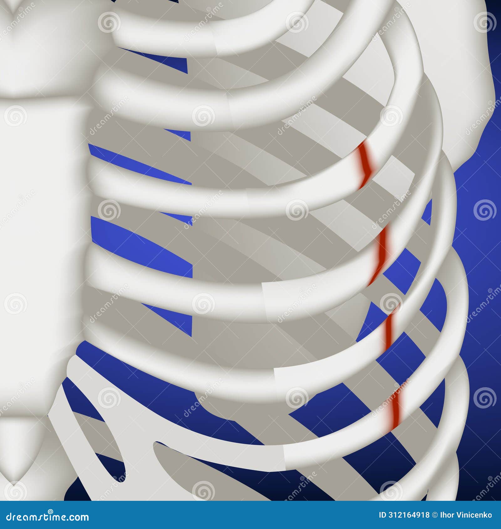 Broken Ribs on a Blue Background, Close-up. Stock Vector - Illustration ...
