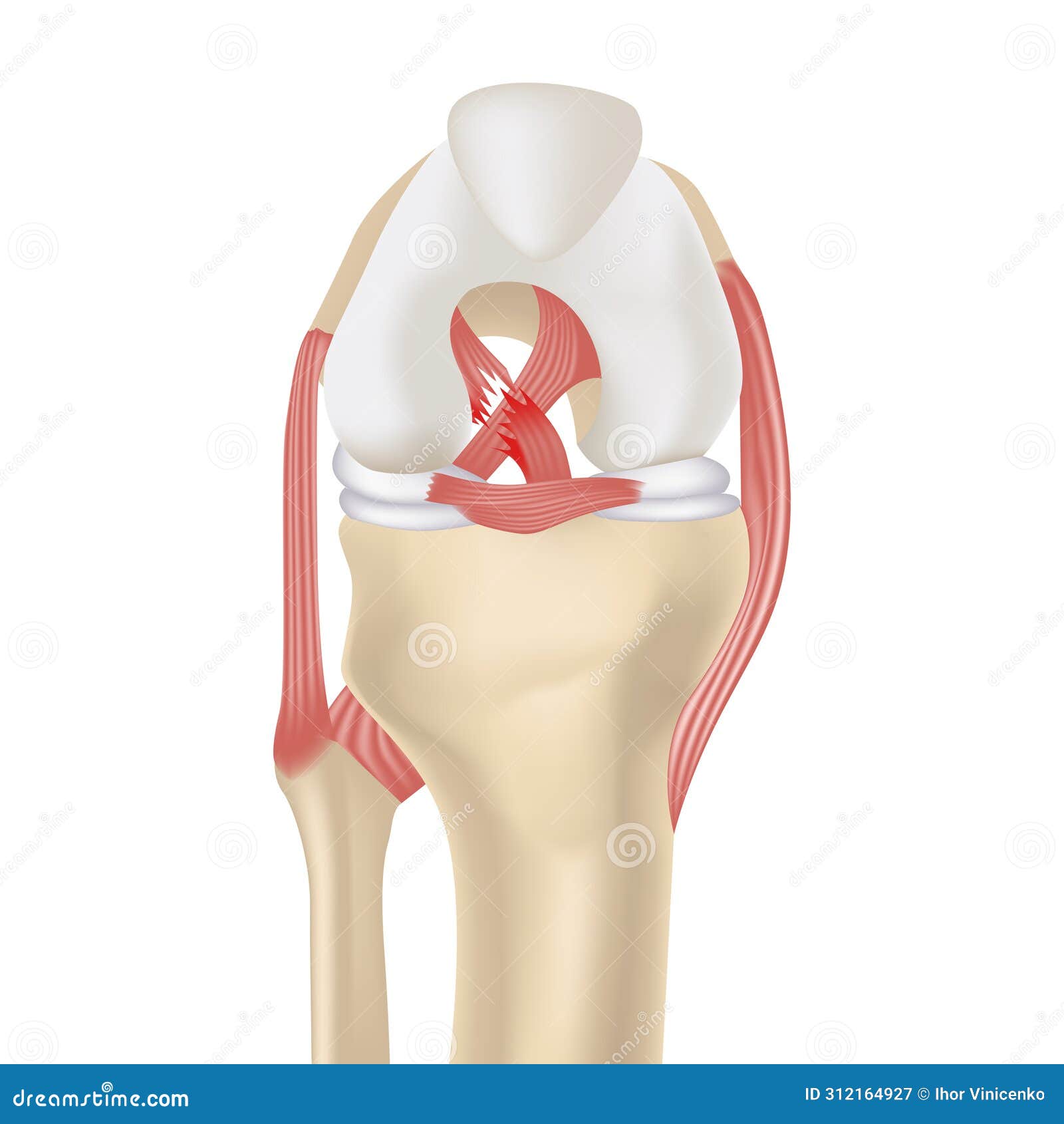 Cruciate Ligament Rupture. Realistic Rendering of the Knee Joint ...