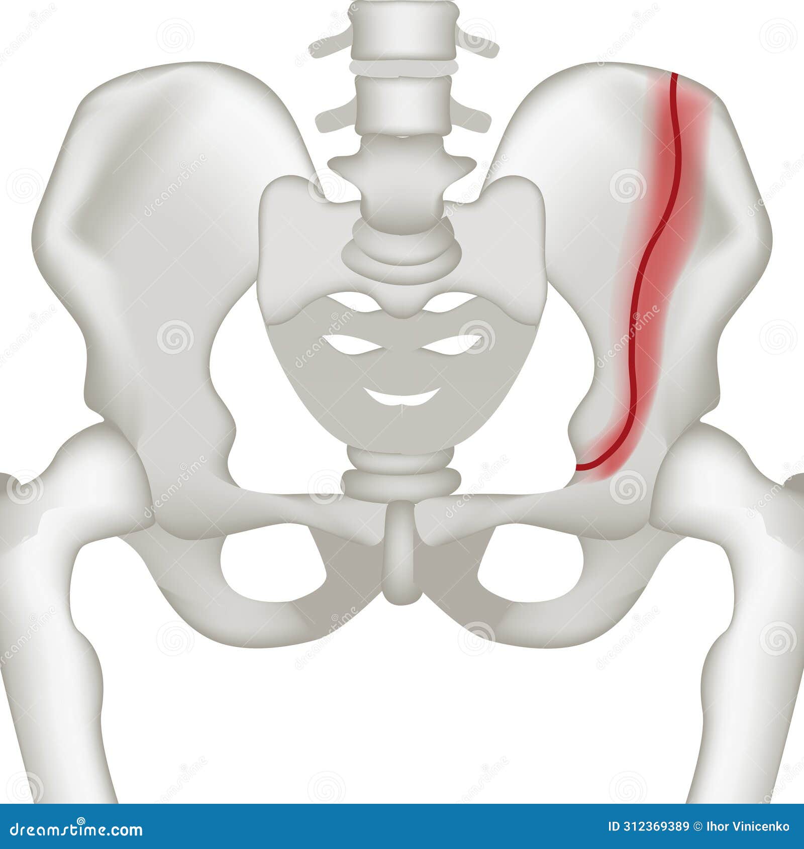 Vertical Frature of the Human Pelvic Bone. Realistic Rendering for ...