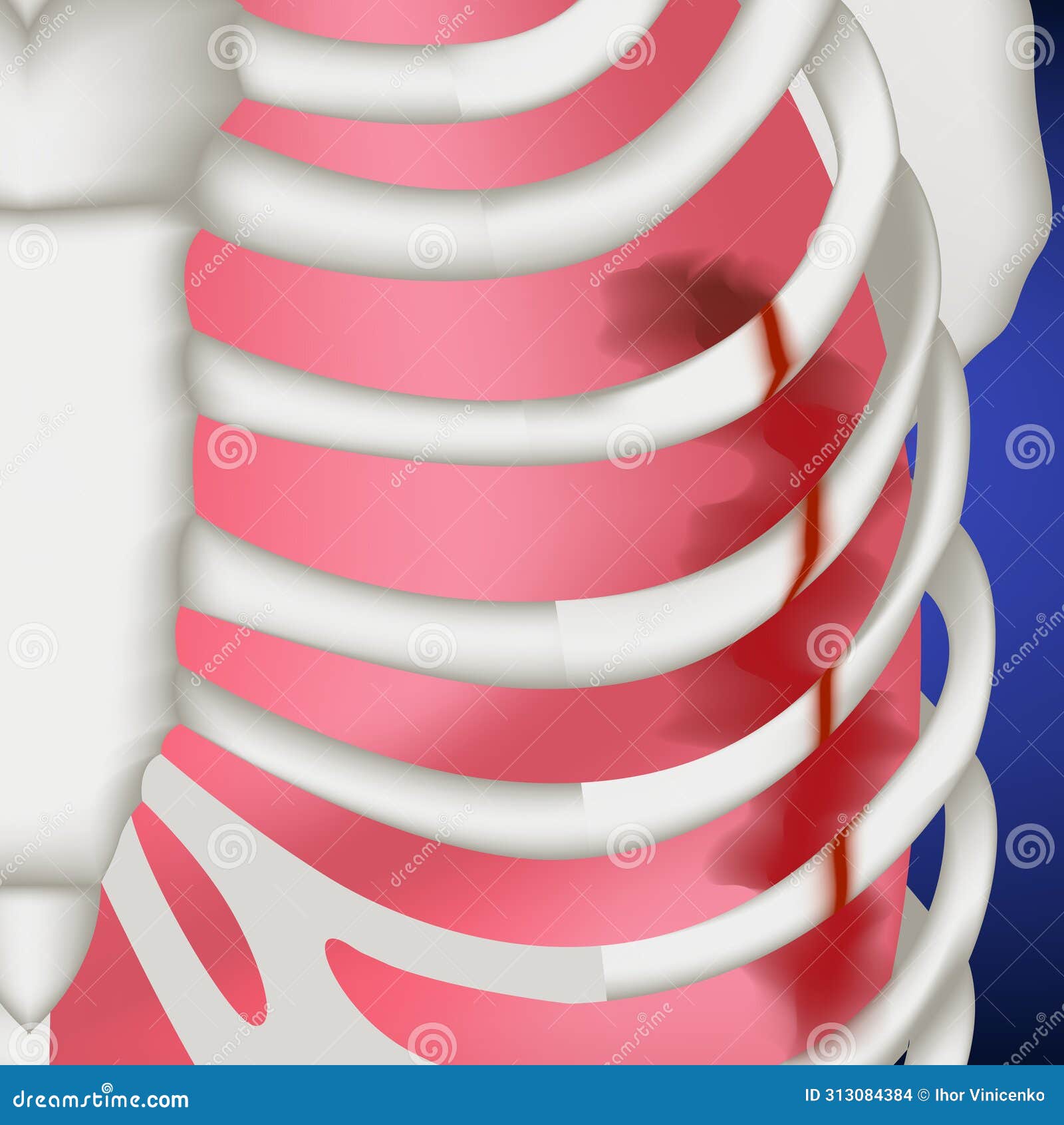 Broken Ribs of a Man with Lung Damage. Stock Vector - Illustration of ...