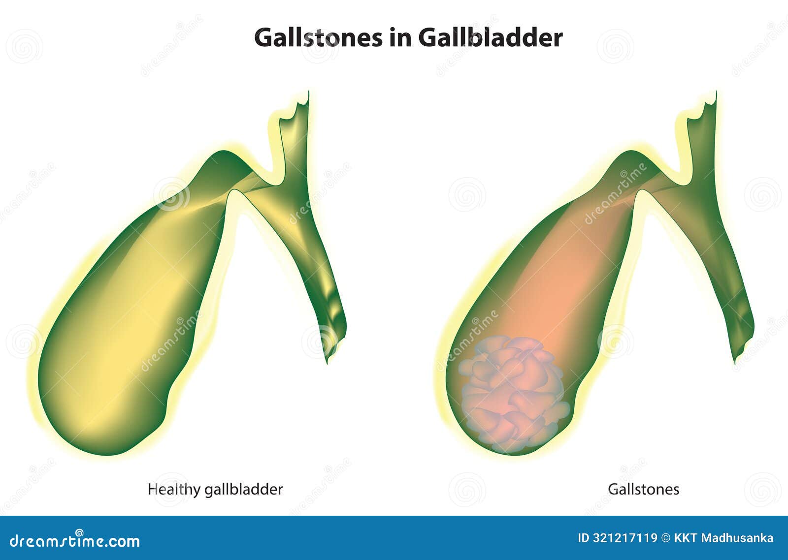 Gallstones In The Gallbladder Medical Animation Stock Photo ...