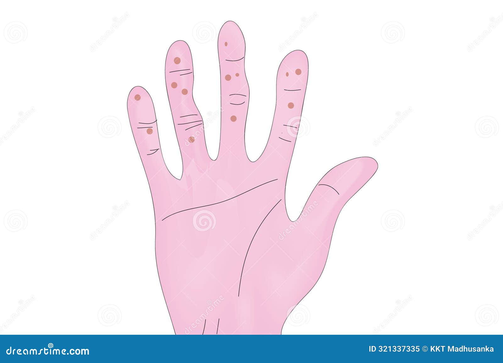 Signs Of Sepsis As Infection Blood Poisoning Symptoms Outline ...