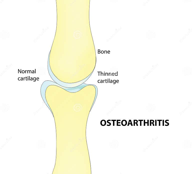 Osteoarthritis diagram stock vector. Illustration of swelling - 322187607