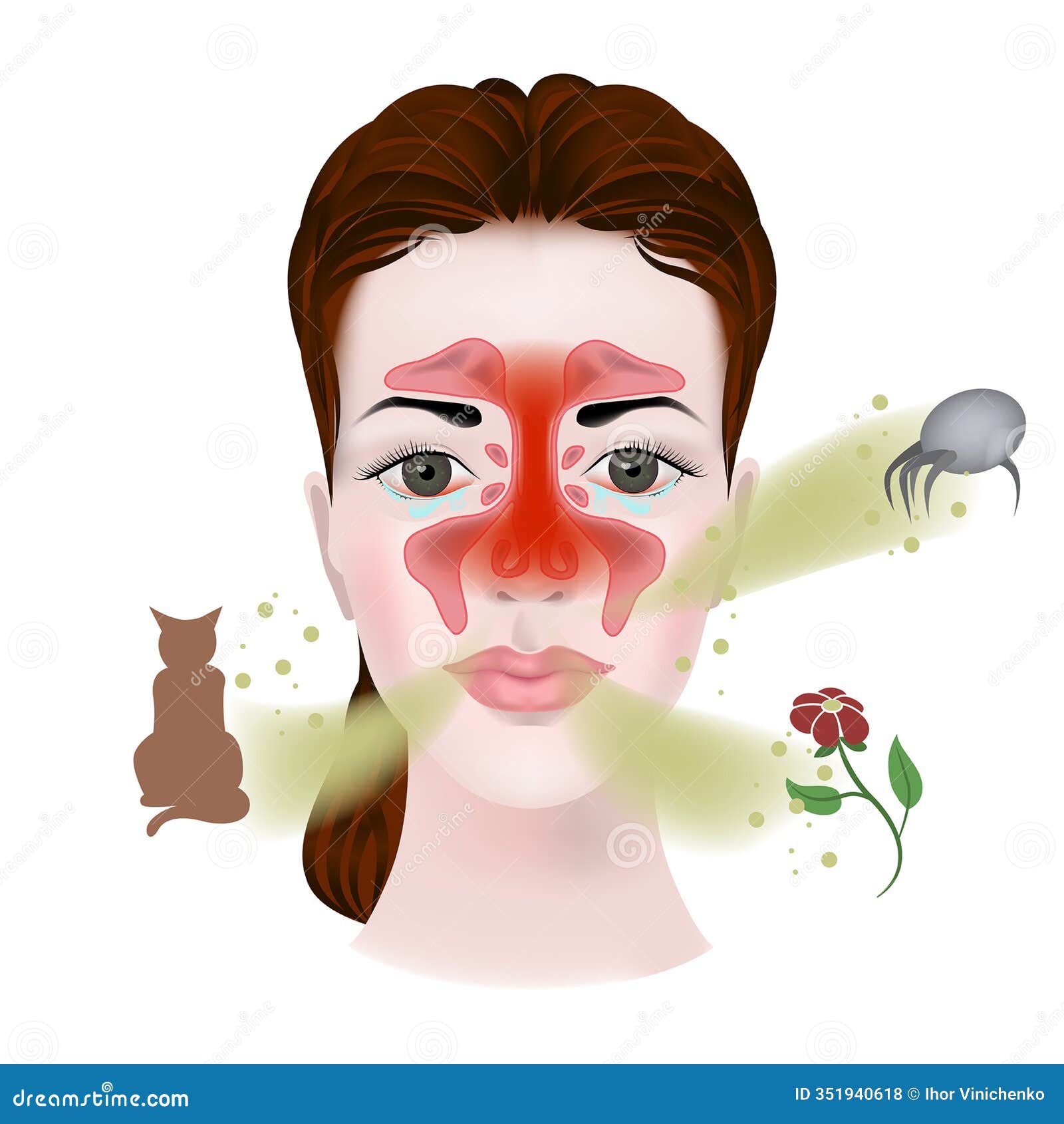 Allergic Rhinitis Symptoms Illustrated Diagram Cartoon Vector ...
