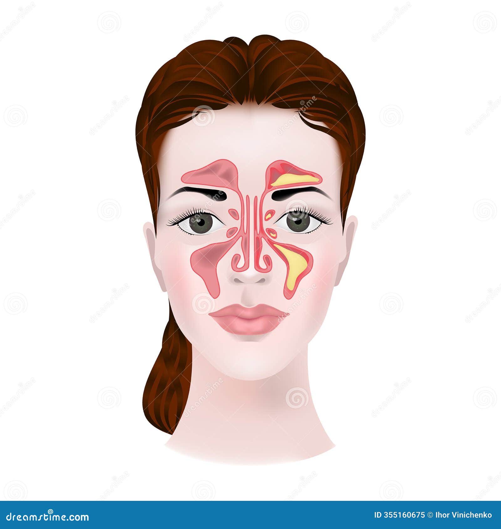 Sinusitis. Image of the Maxillary Sinuses on a Woman S Face with a ...