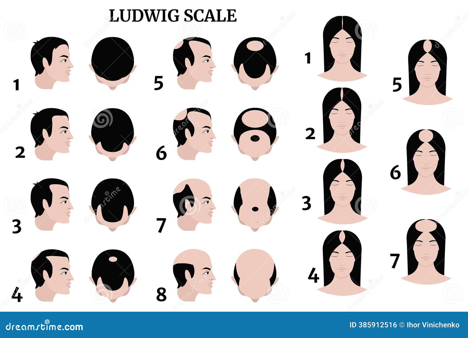 Ludwig Scale Illustration Showing Stages Of Hair Loss In Men And Women ...