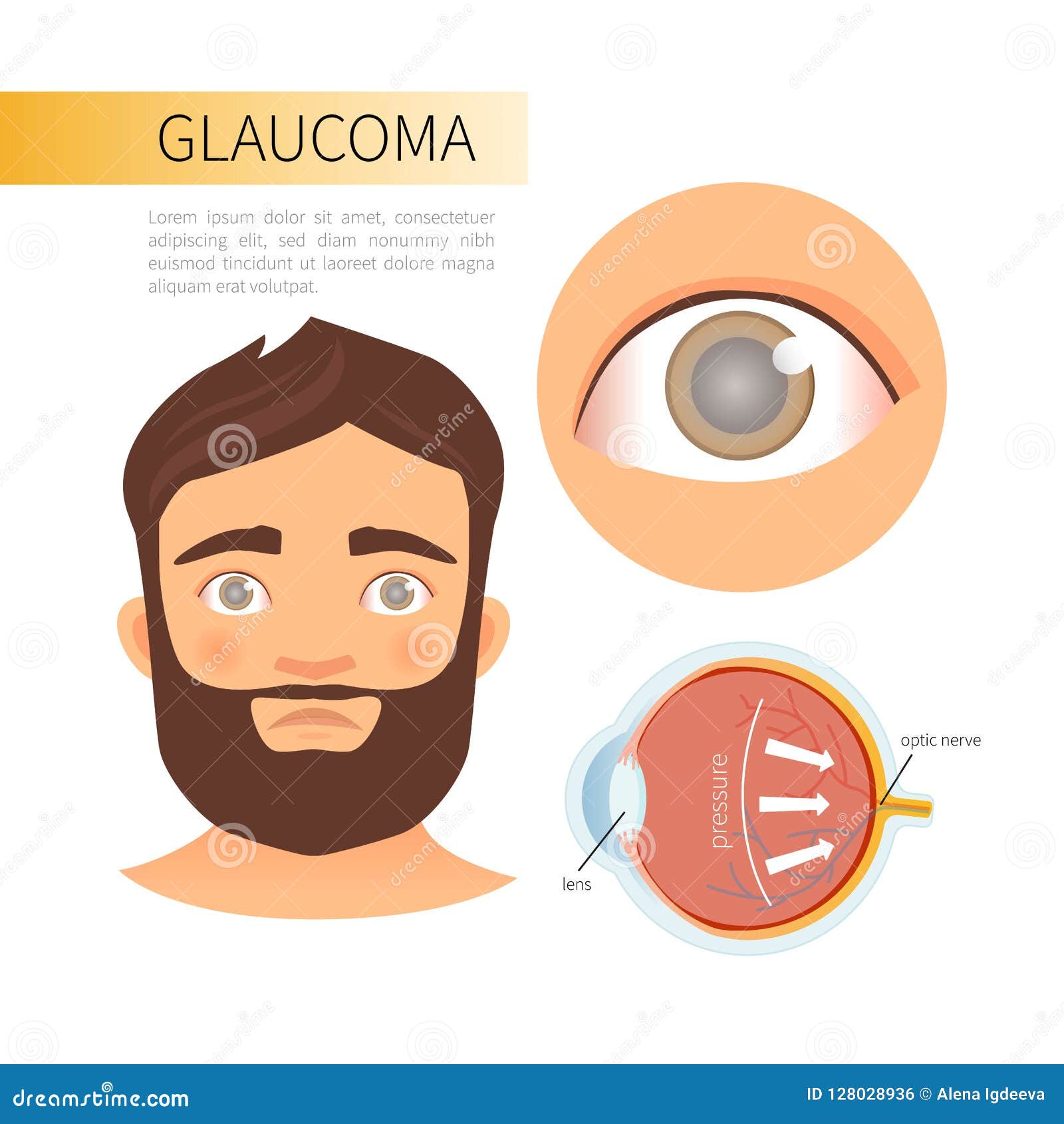 Infographic Eyes Disease Cartoon Vector | CartoonDealer.com #128028939