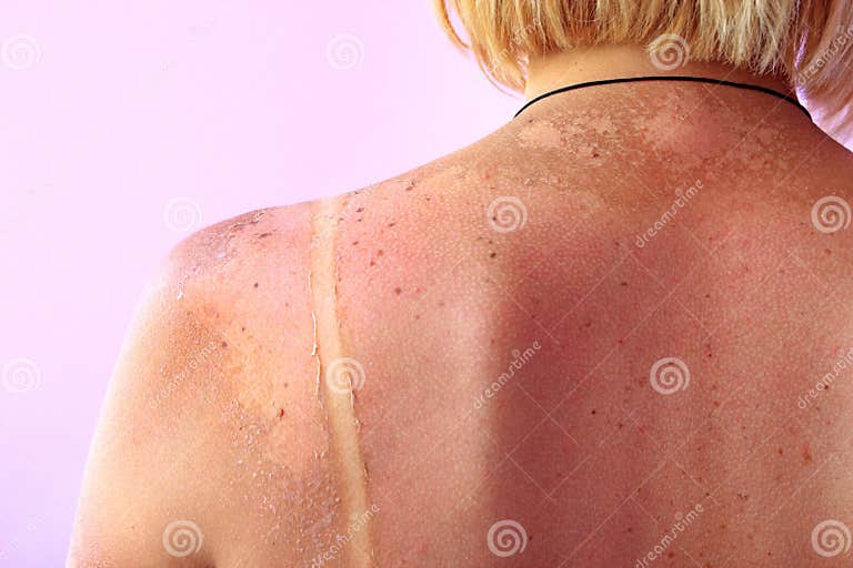 Traces Of Sunburn On The Back Of A Woman Female Body Stock Image