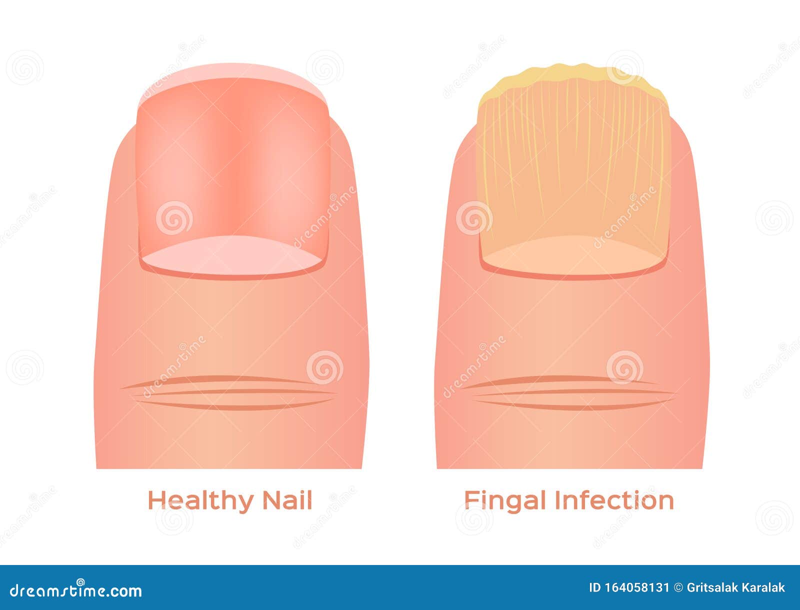 Toe Nail Fungal Infection Vector Stock Vector - Illustration of ...