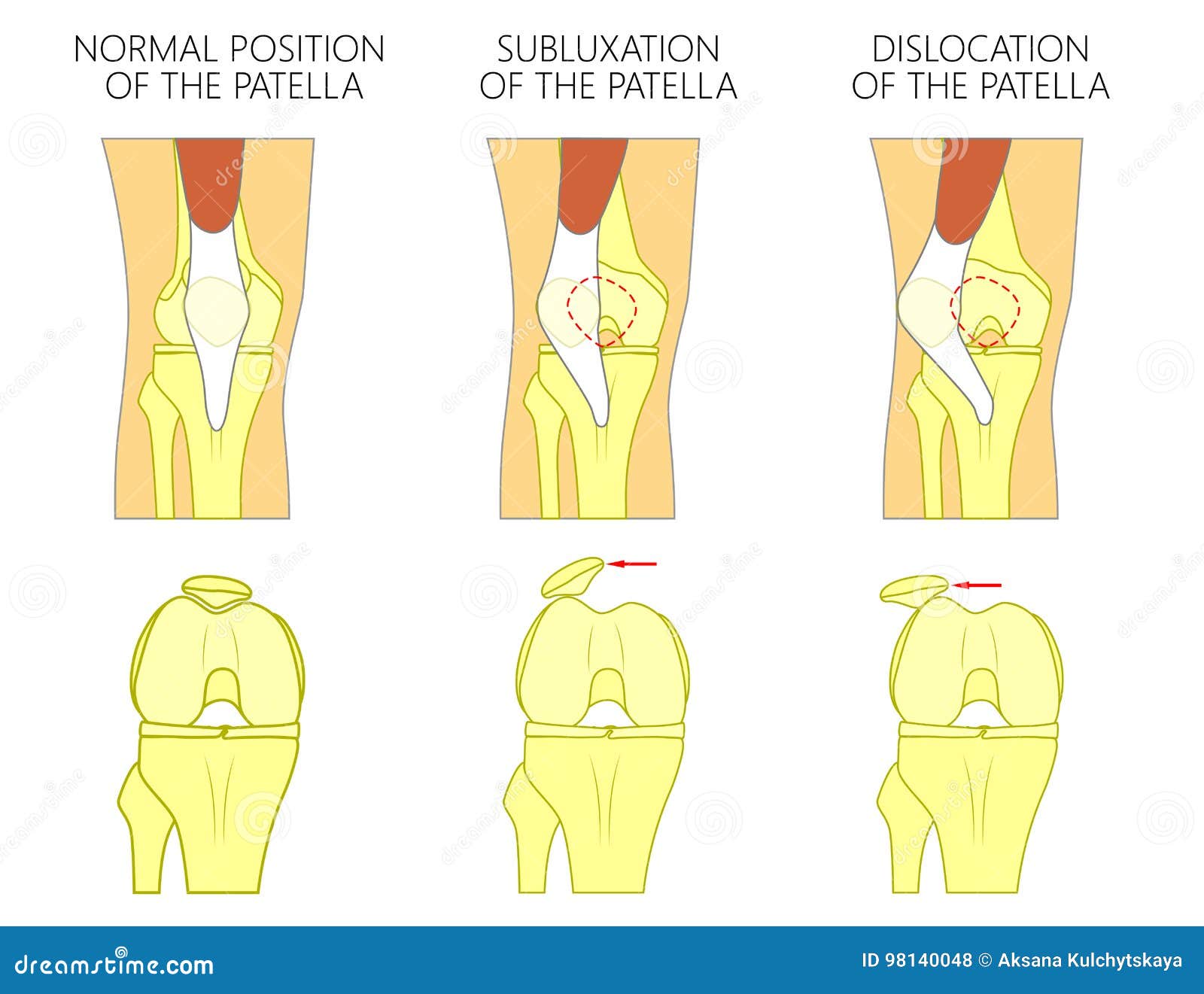Problem_Dislocation De La Junta De Rodilla De La Rótula Ilustración del ...
