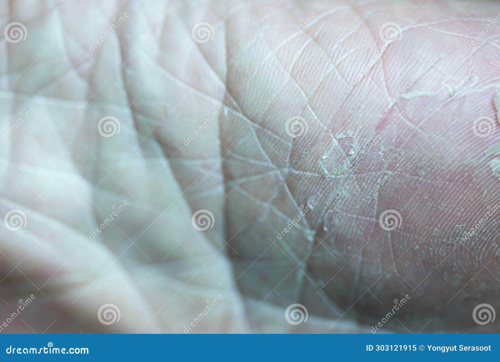 Problem of Dry, Cracked and Peeling Skin Stock Image - Image of ...