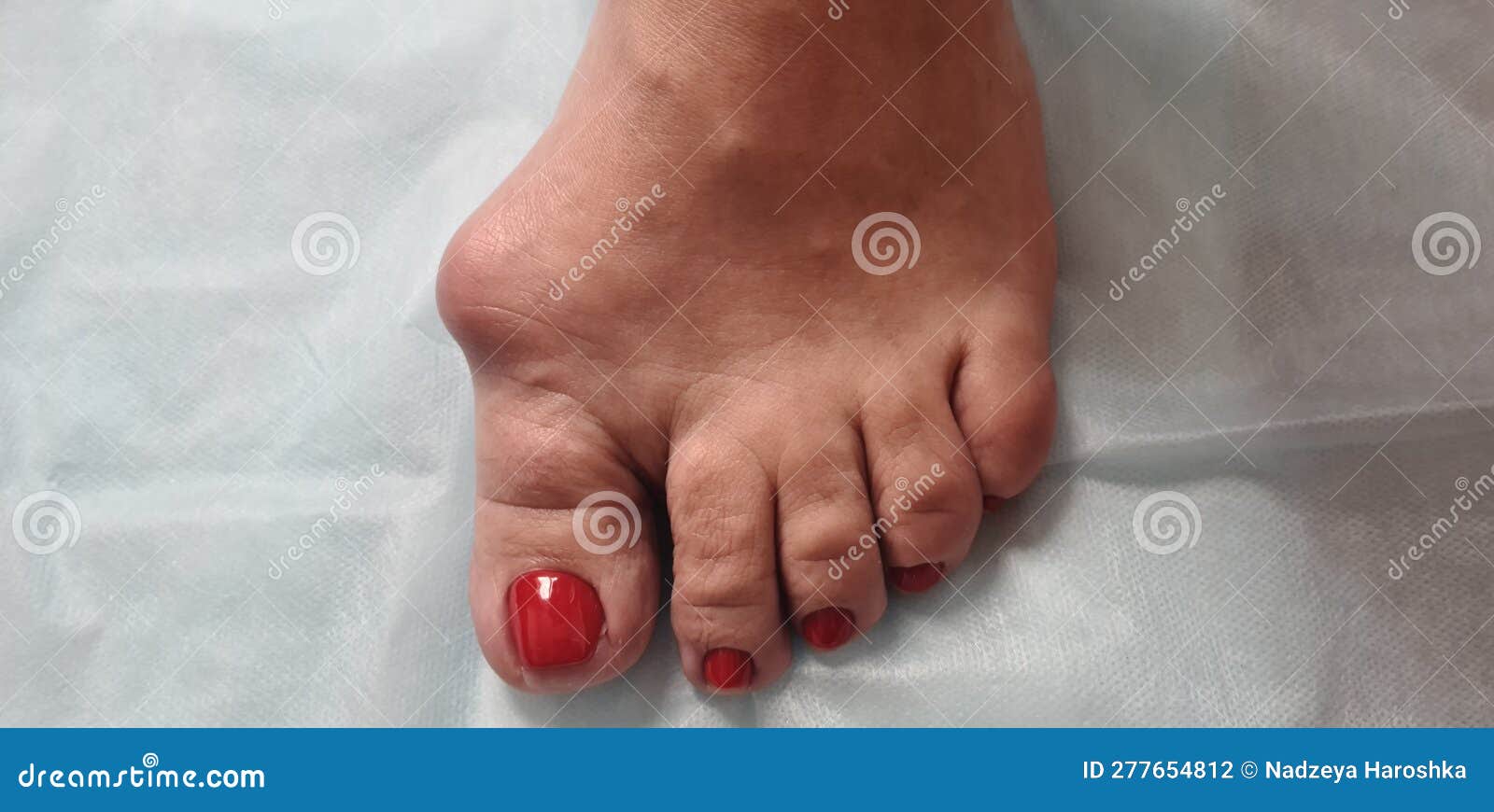 Bursitis Of The Big Toe. Callus On The Leg. X-ray Of The Foot With The ...