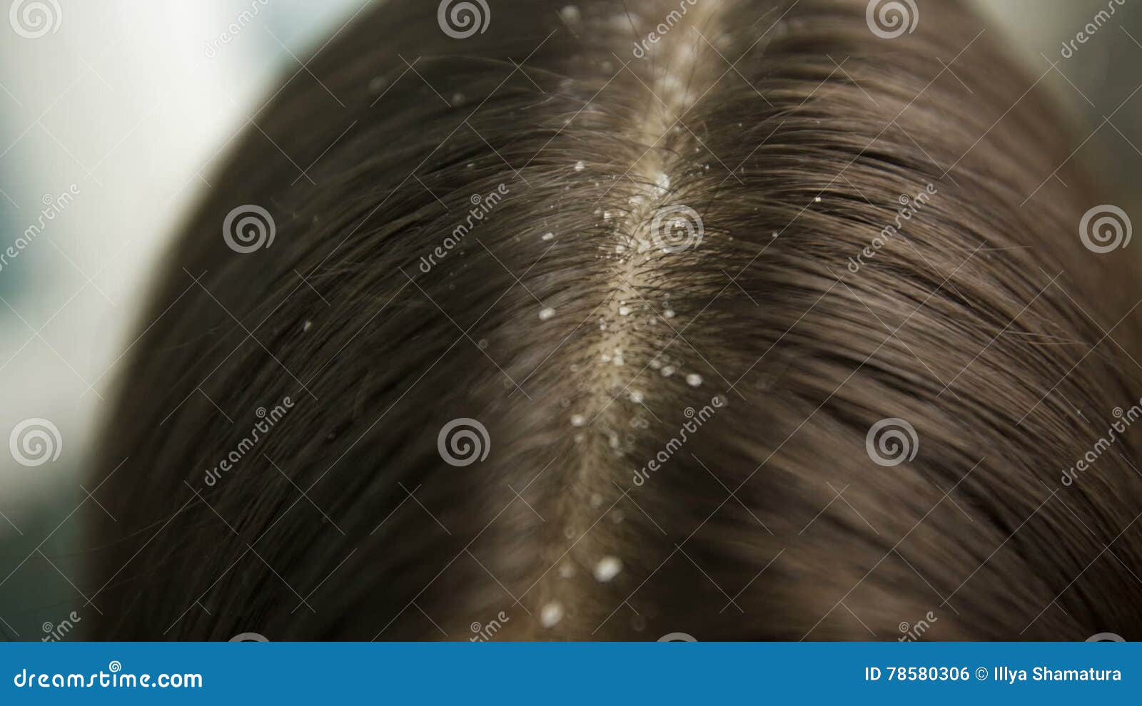 Problem hair with dandruff stock footage. Video of despair - 78580306
