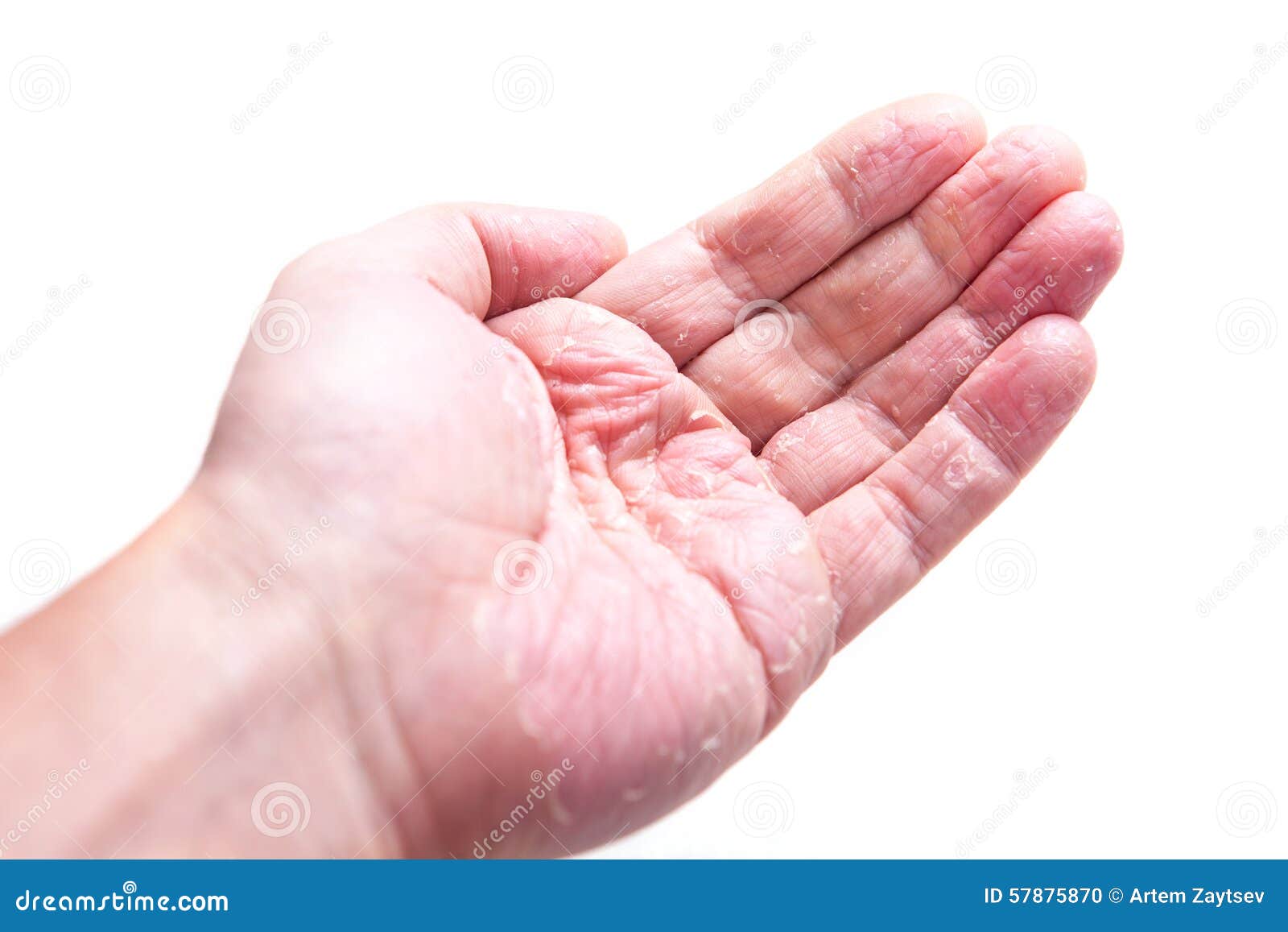 The Problem With Many People - Eczema On Hand Stock Photo - Image of ...