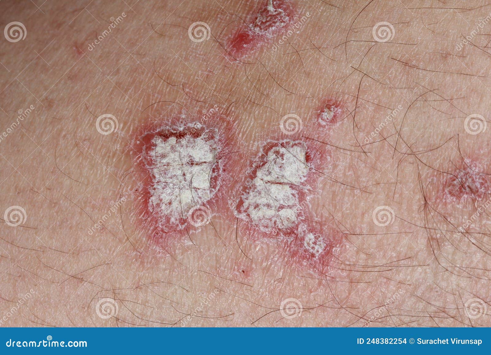 Psoriasis is an Autoimmune Disease that Affects the Skin Causing Red ...