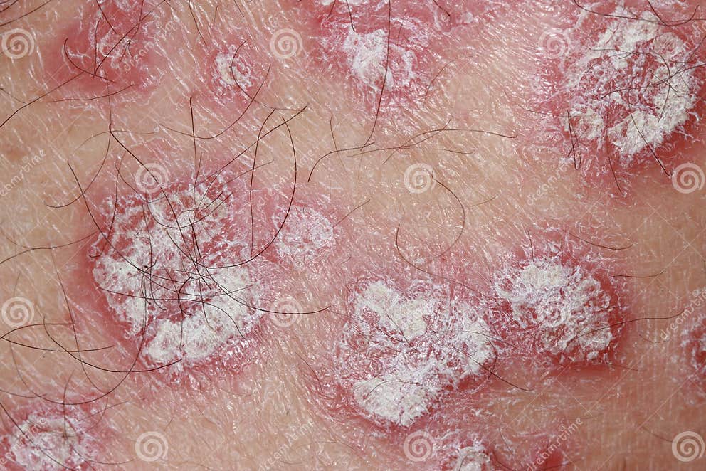 Psoriasis Is An Autoimmune Disease That Affects The Skin Causing Red