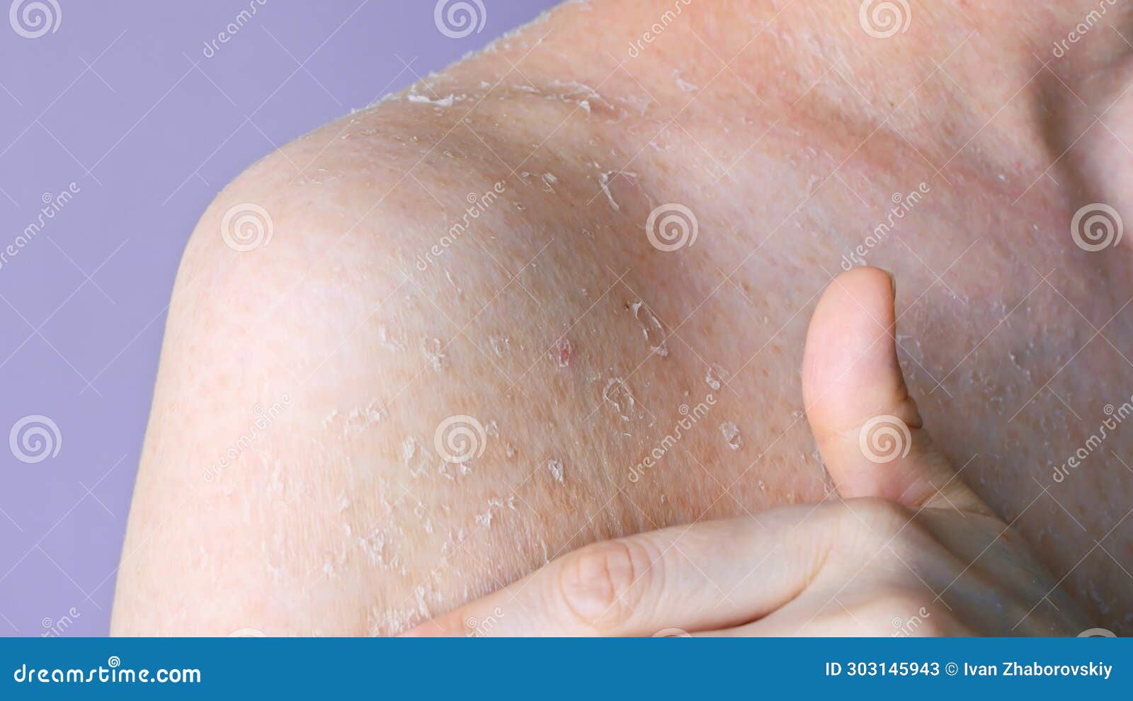 Problematic Dry Skin on Shoulder Close-up Front View Flaking As ...