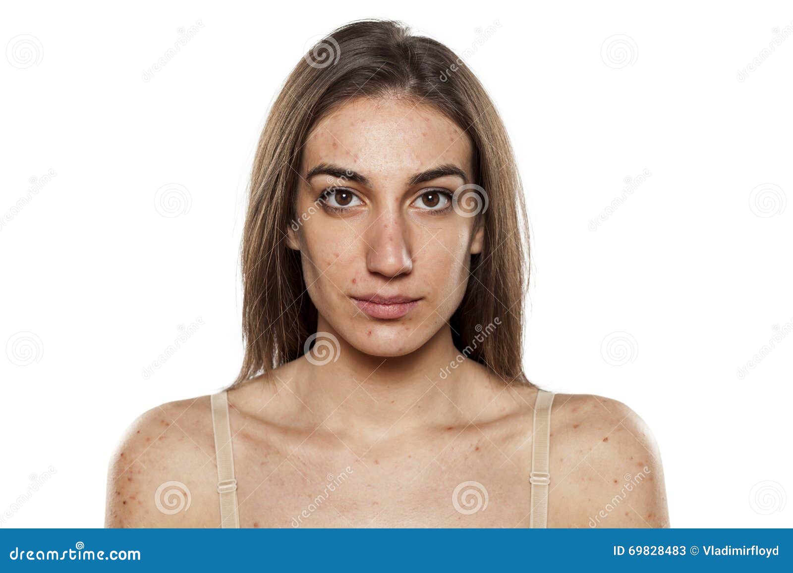 Woman With Problematic Skin And Acne Scars. Pigmentation On Face Woman ...