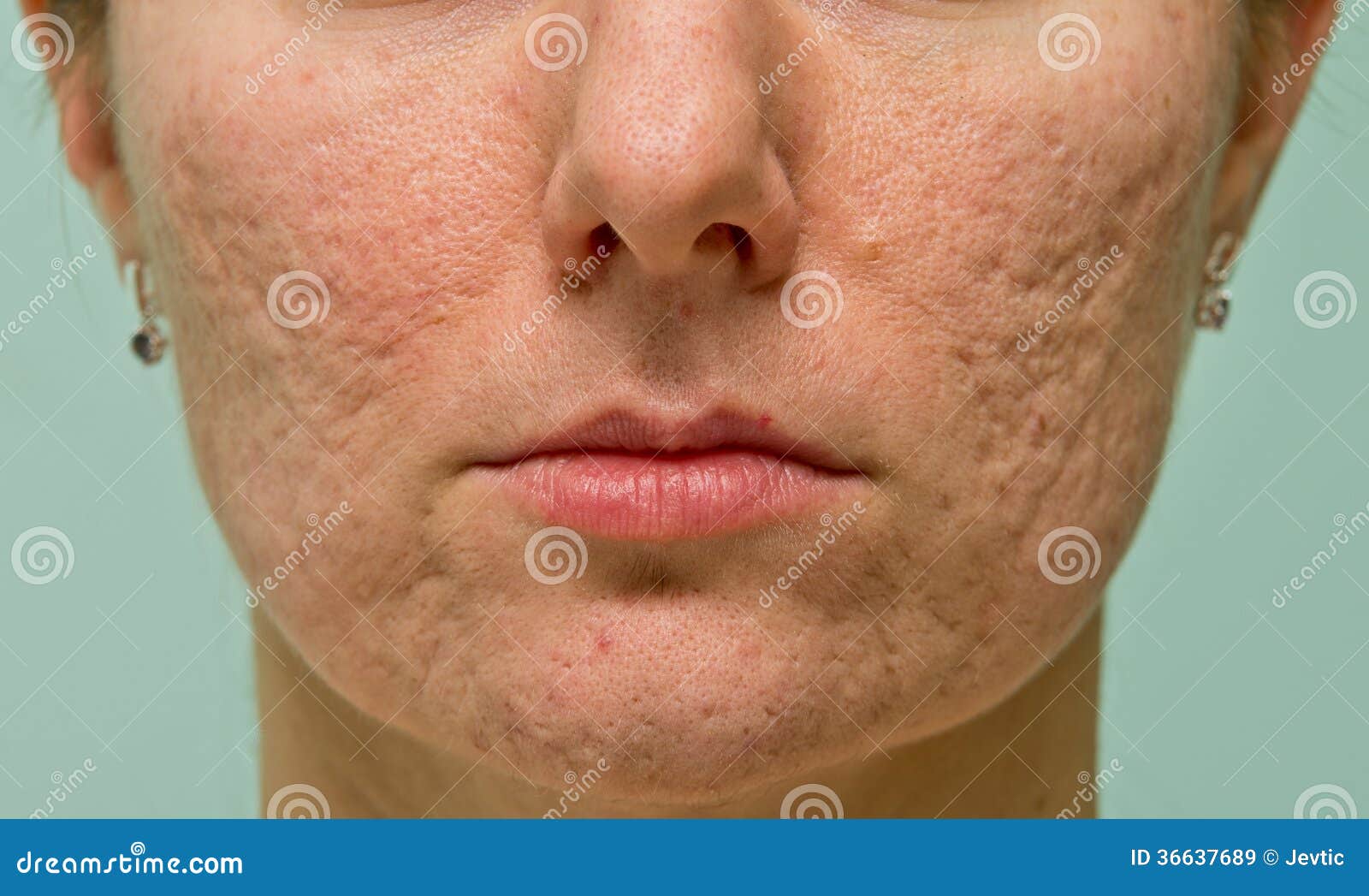 Problematic skin stock image. Image of bump, blemish - 36637689