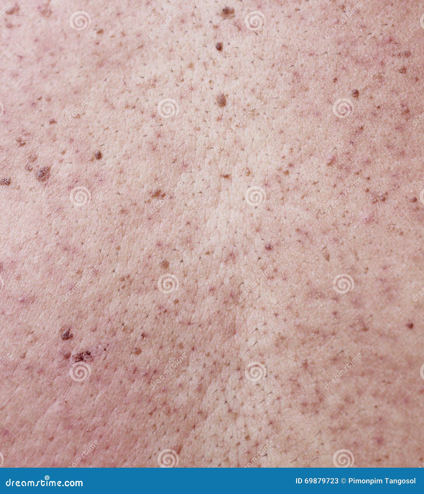 Problematic skin stock image. Image of acne, girl, pimple - 69879723