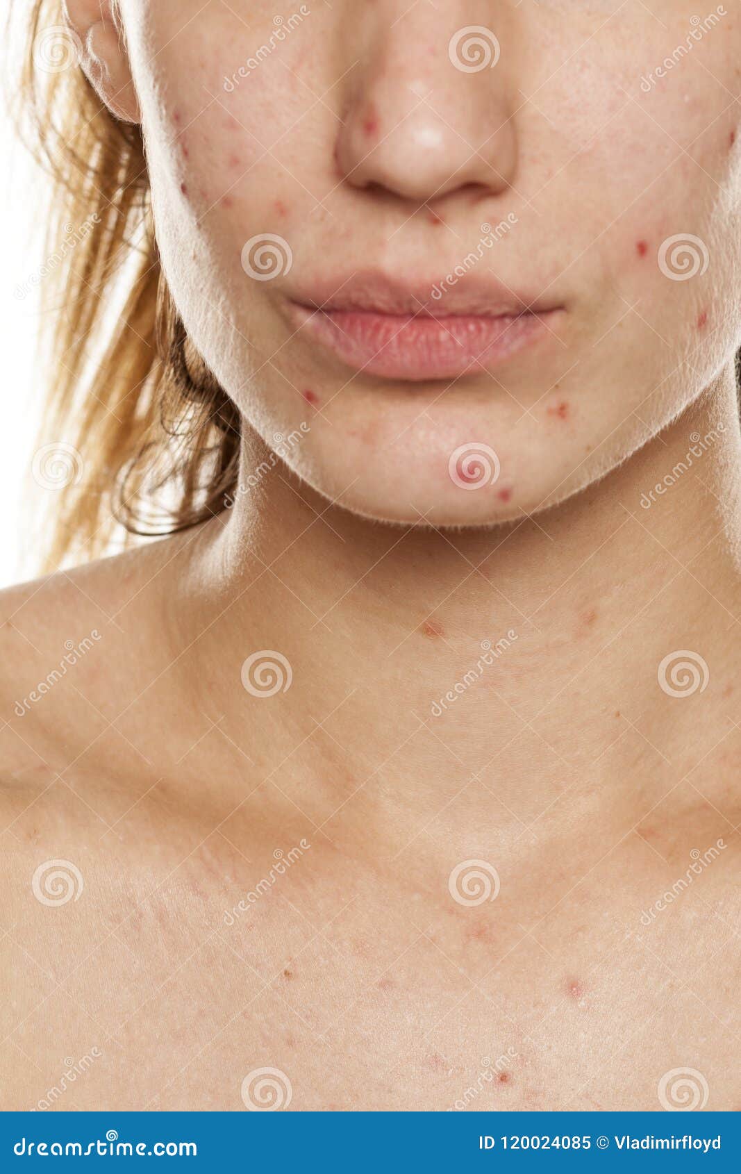 Problematic skin stock image. Image of dermatology, makeup - 120024085