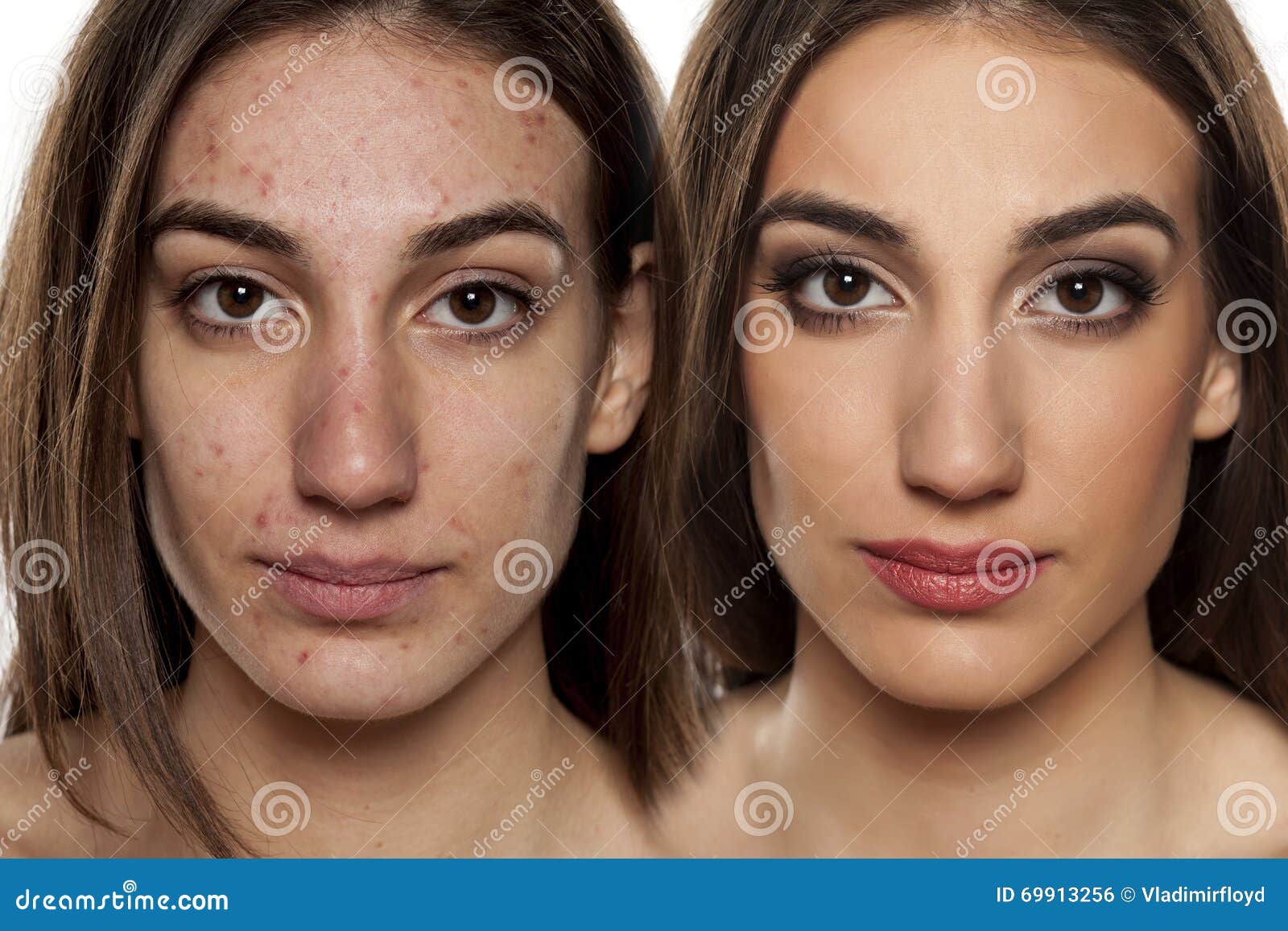 Problematic Skin before and after Makeup Stock Photo - Image of eyelash ...