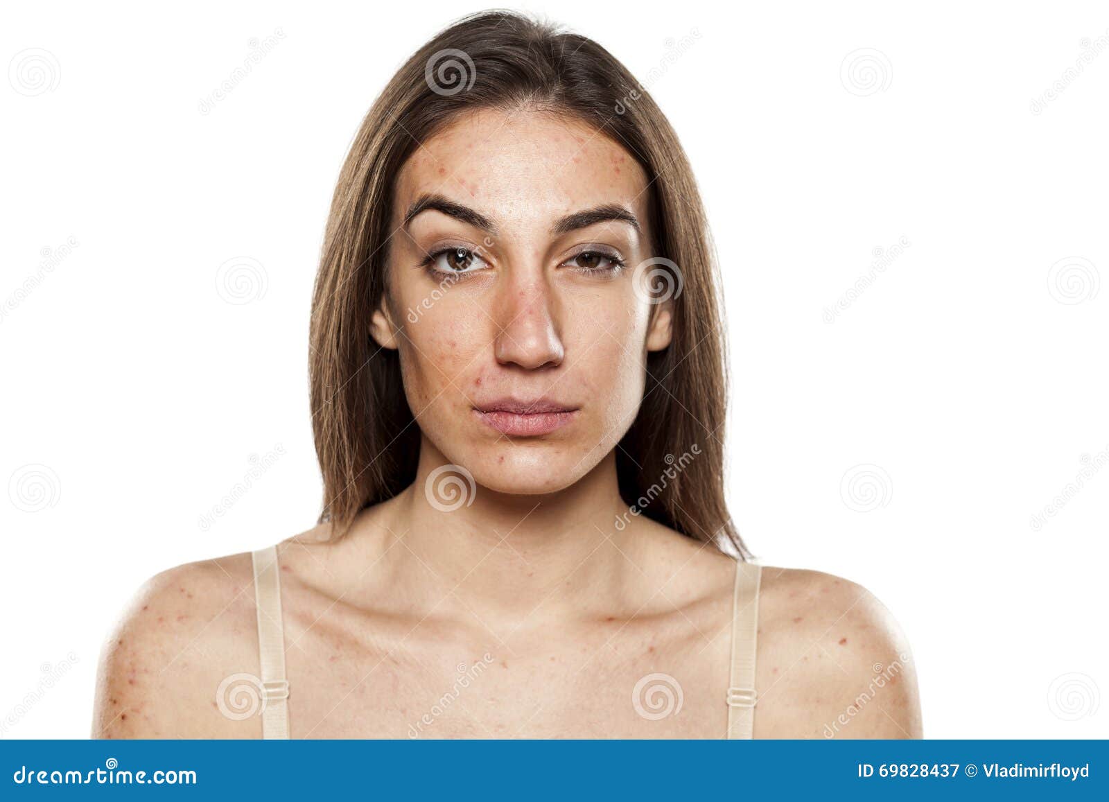 Problematic skin stock image. Image of brunette, girl - 69828437