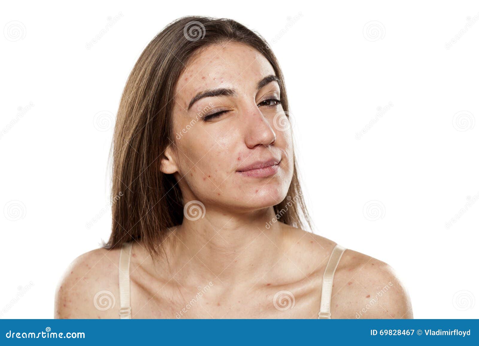 Woman With Problematic Skin And Acne Scars. Pigmentation On Face Woman ...