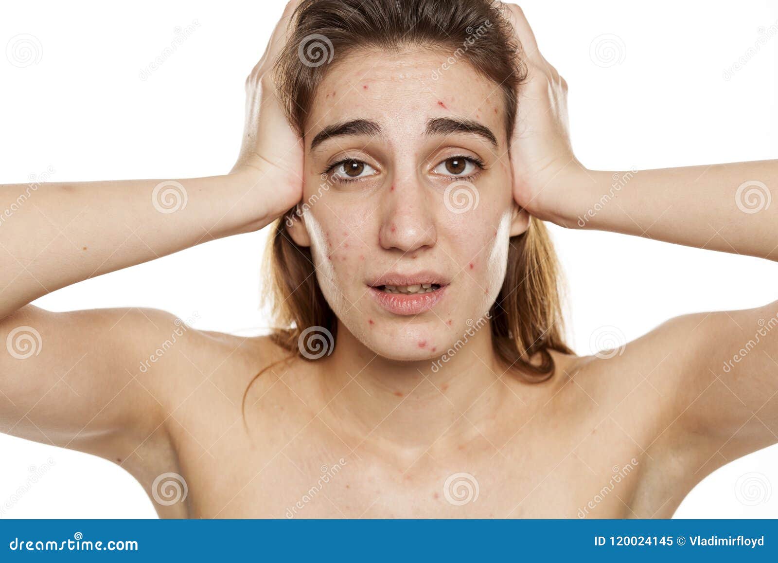 Problematic skin stock image. Image of acne, puberty - 120024145
