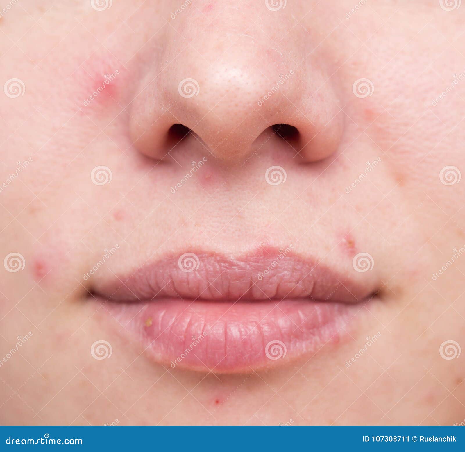 Problematic woman skin stock image. Image of background - 107308711