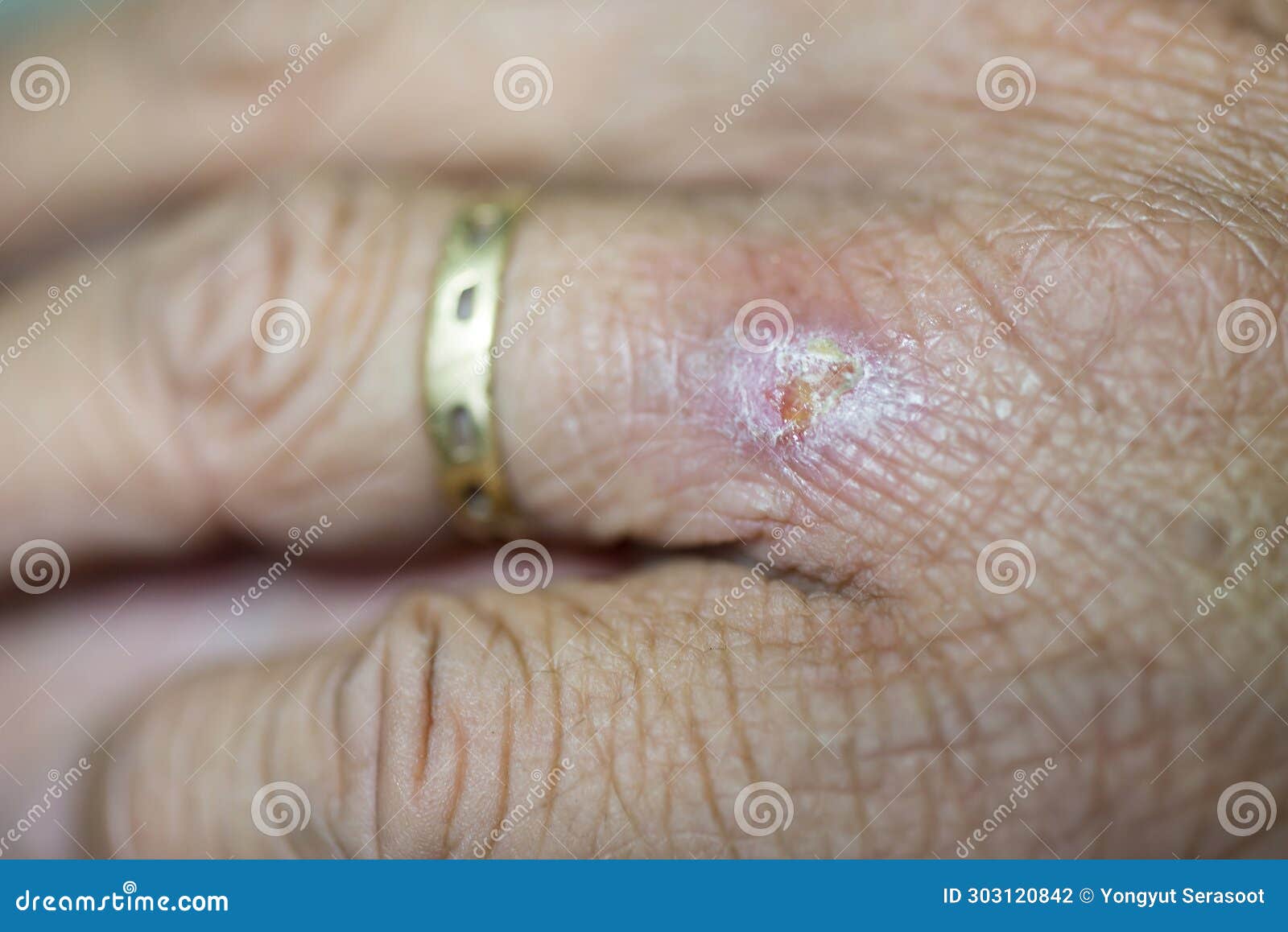 Problems Dry Skin, Wound, Scabs Stock Photo - Image of harsh, crease ...