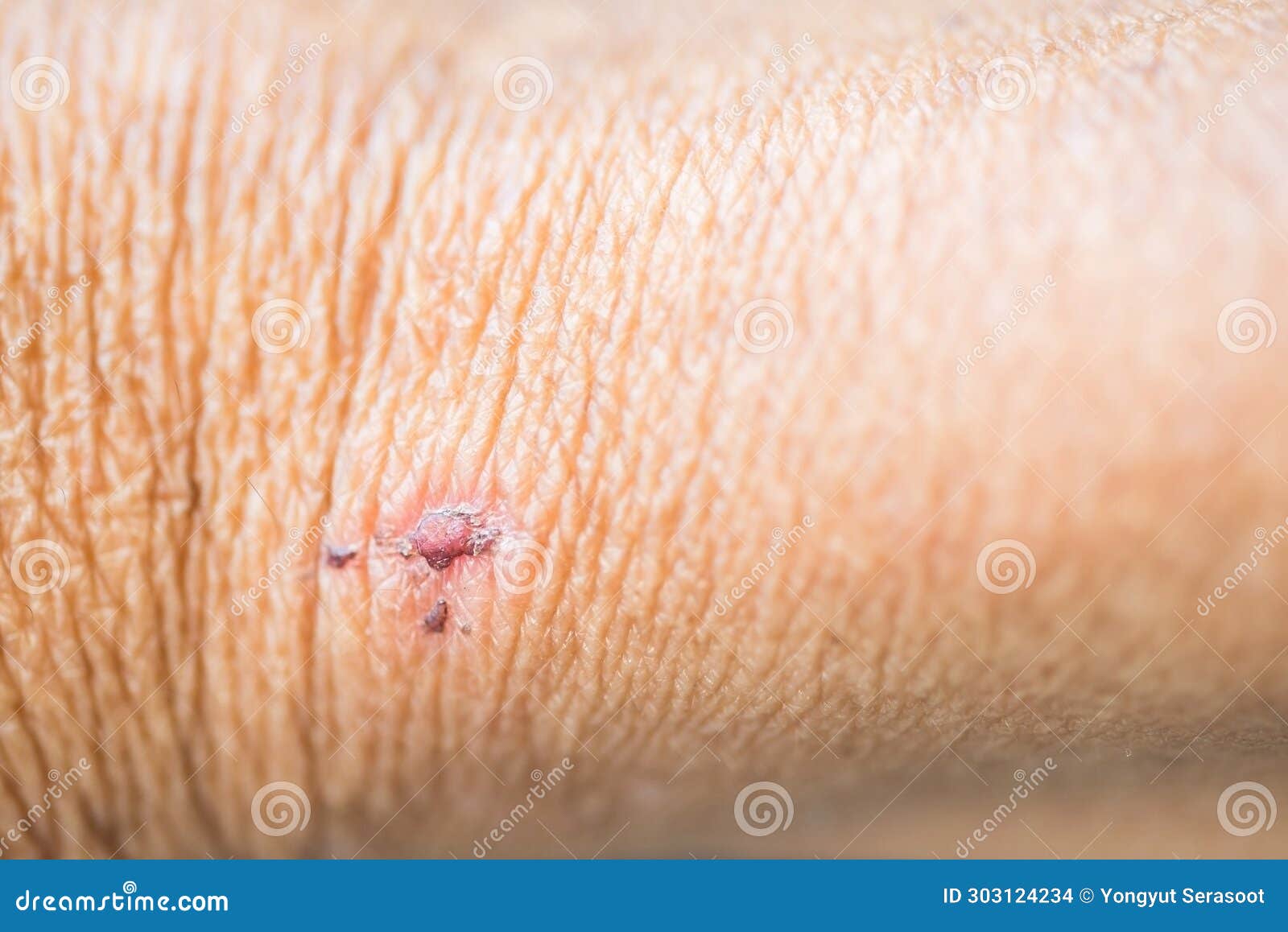 Problems Dry Skin, Wound, Scabs Stock Photo - Image of cracked, coarse ...