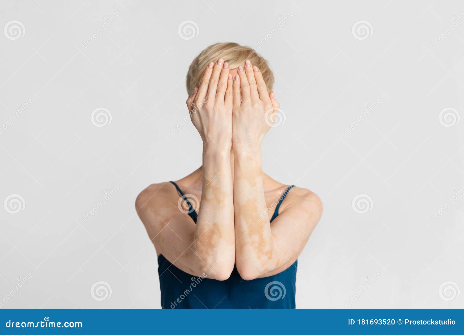 Problems of People with Vitiligo. Woman is Hiding Stock Photo - Image ...