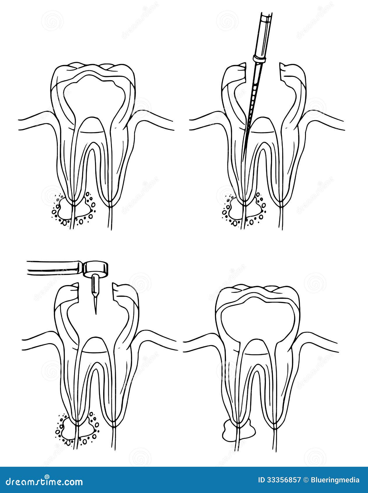 Procedimiento De La Endodoncia Stock de ilustración - Ilustración de ...