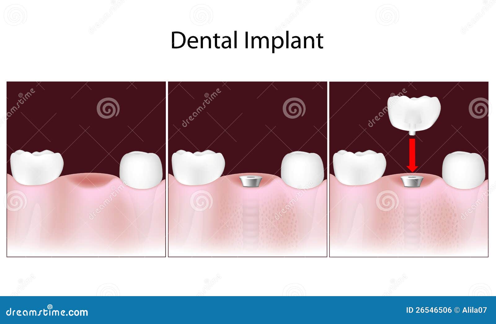 Procedimiento Del Injerto Dental Ilustración del Vector - Ilustración ...