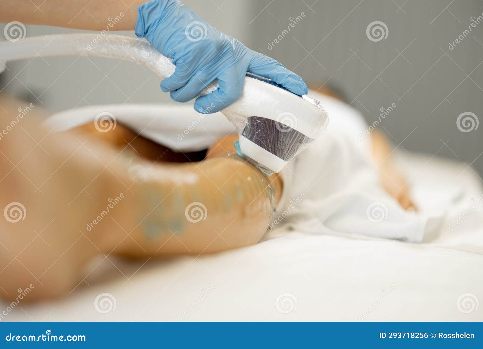 Procedura Di Rimozione Dei Capelli Mediante Laser Sulle Gambe Di Una ... Procedura Di Rimozione Dei Capelli Mediante Laser Sulle Gambe Di Una ...