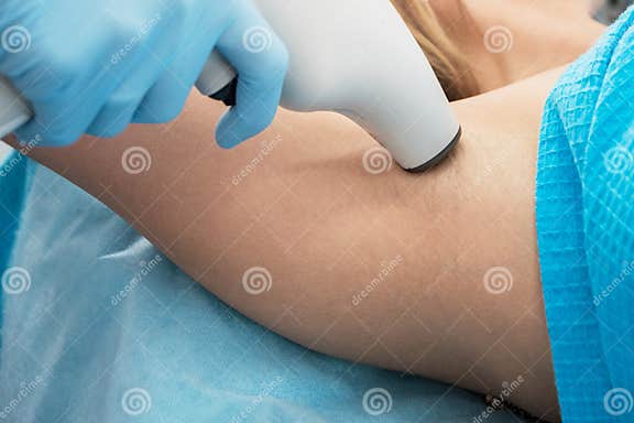 Procedure Against Hyperhidrosis Stock Image - Image of healthy, body ...