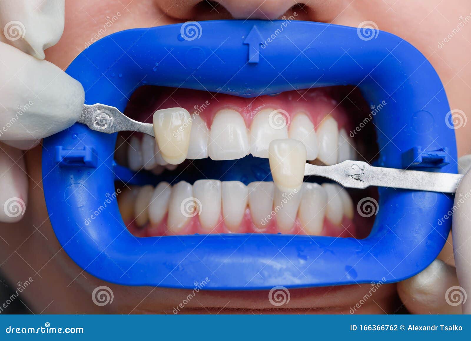 Procedure for Comparing the Color Shades of Teeth with Tests after ...
