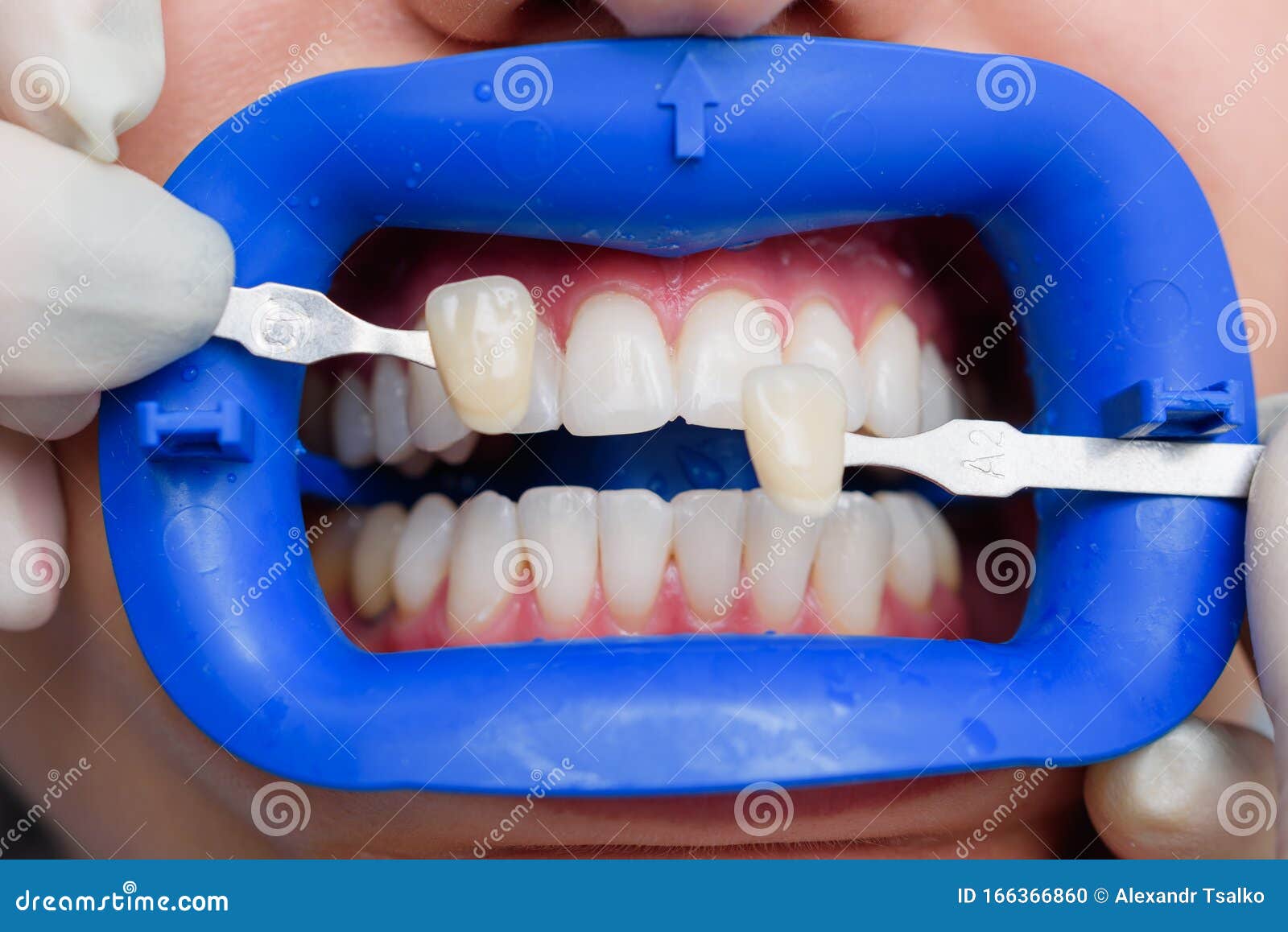 Procedure for Comparing the Color Shades of Teeth with Tests after ...
