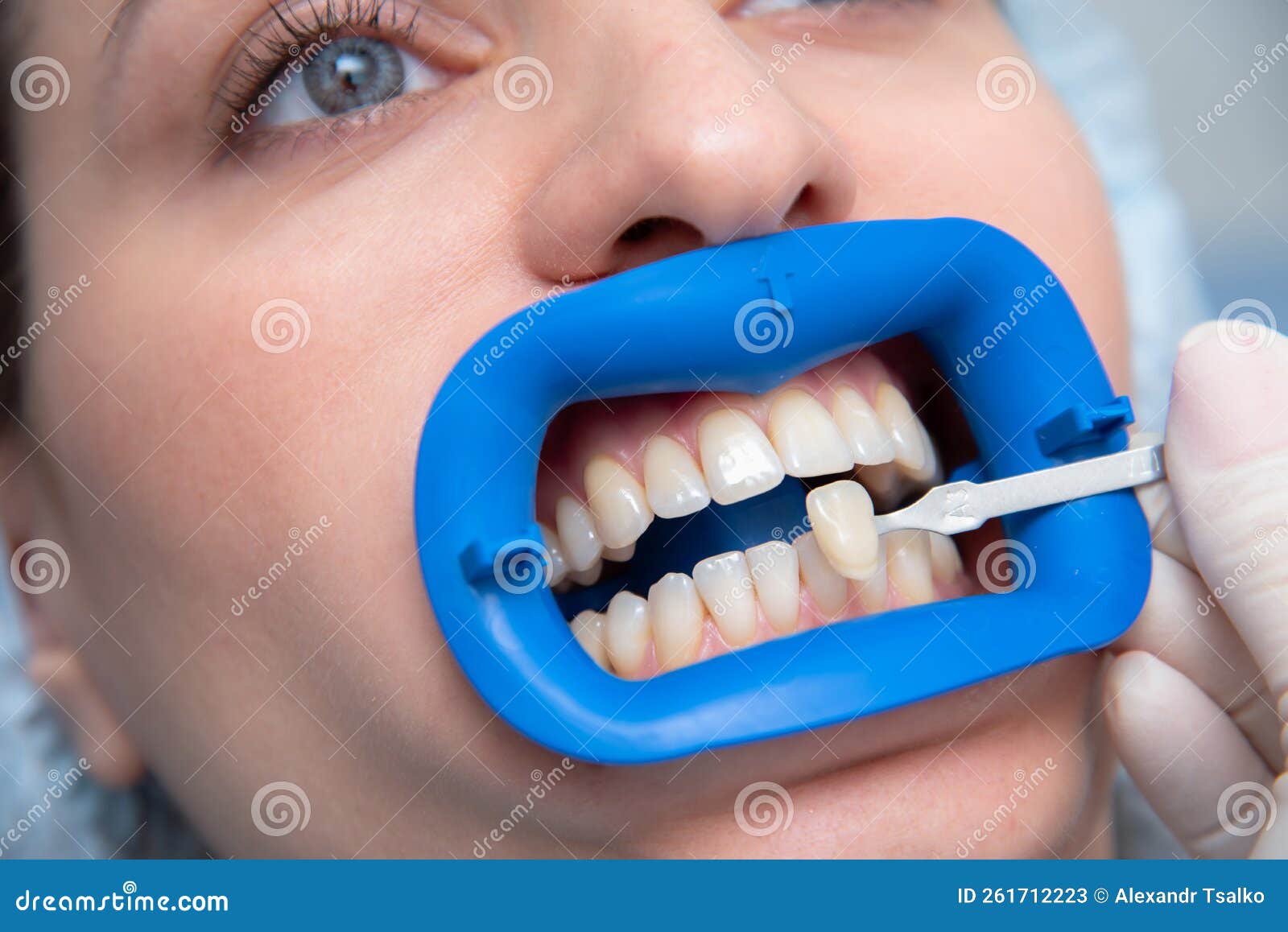 Procedure for Comparing the Color Shades of Teeth Using Tests before ...
