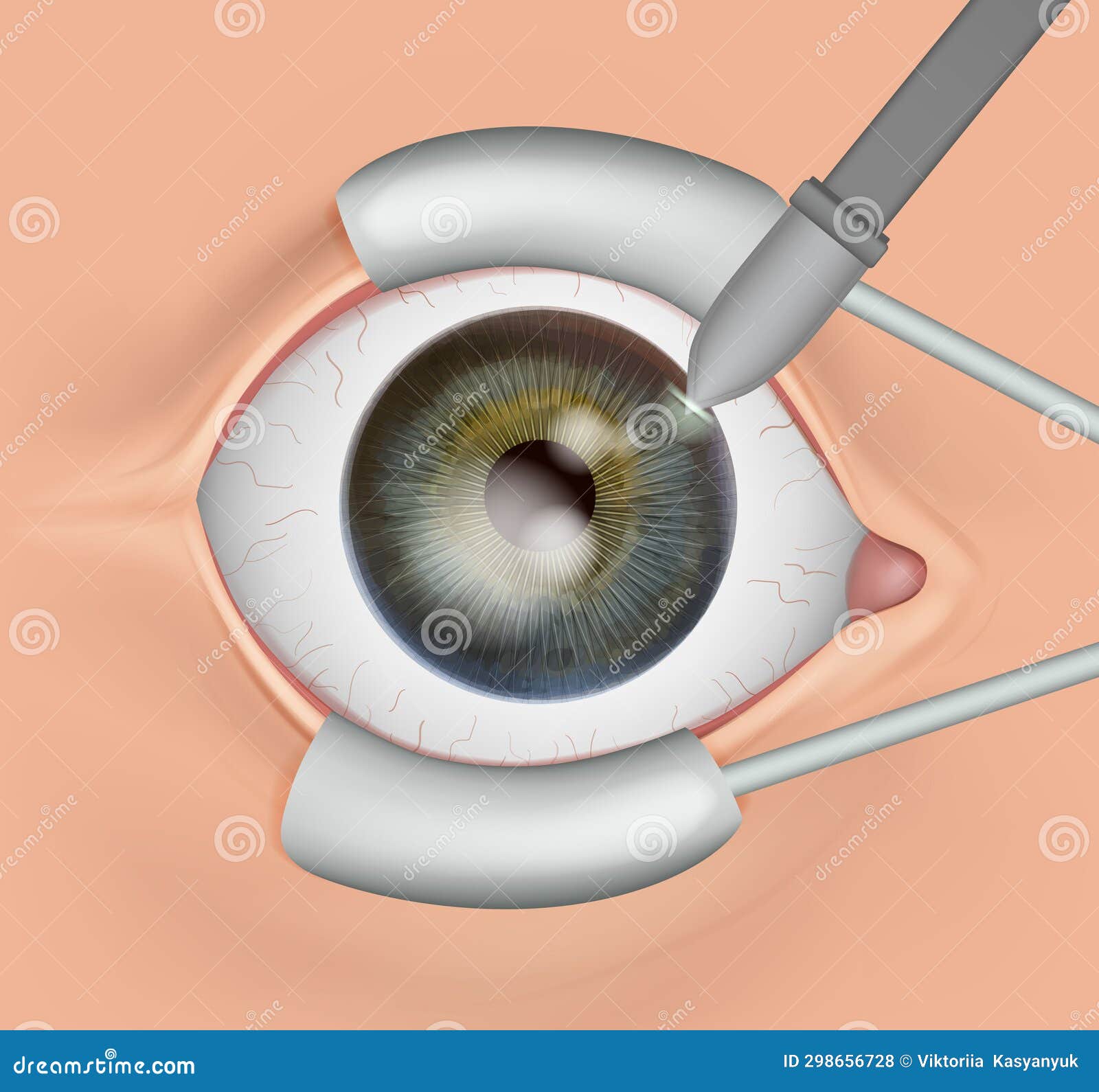 The Procedure of Eye Surgery. Anatomy of the Eye Stock Illustration ...