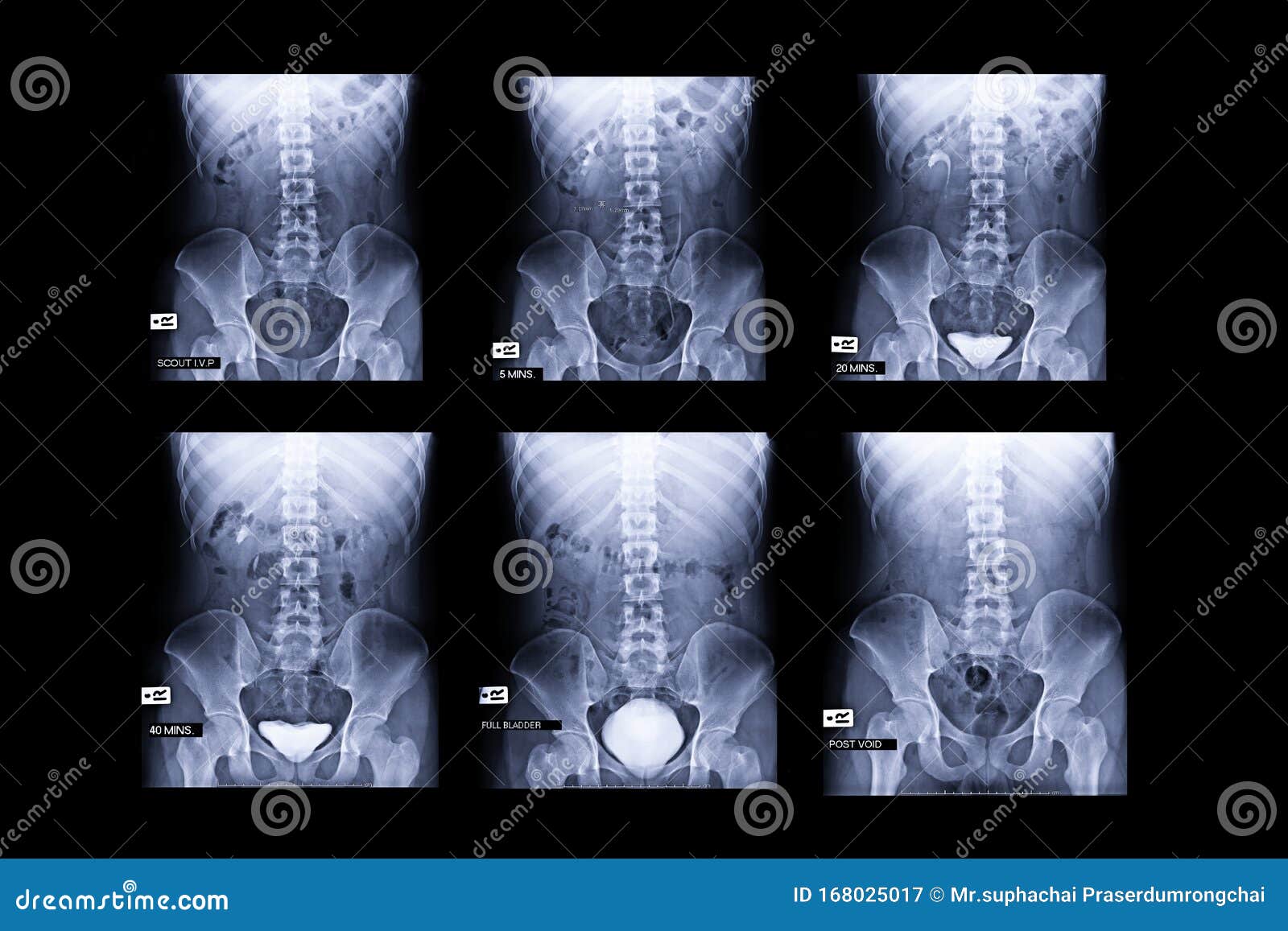 Procedure Of Intravenous Pyelogram Or I V P Stock Illustration