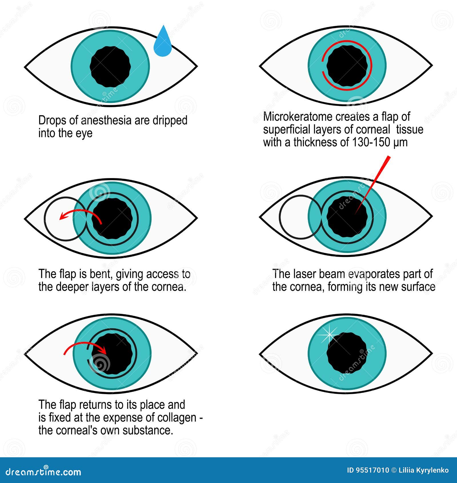 Laser Correction And Vision Surgery Cartoon Vector | CartoonDealer.com ...