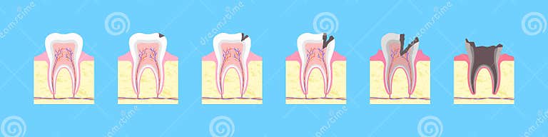 Process of Carious Destruction of Tooth Stock Vector - Illustration of ... Process of Carious Destruction of Tooth Stock Vector - Illustration of ...