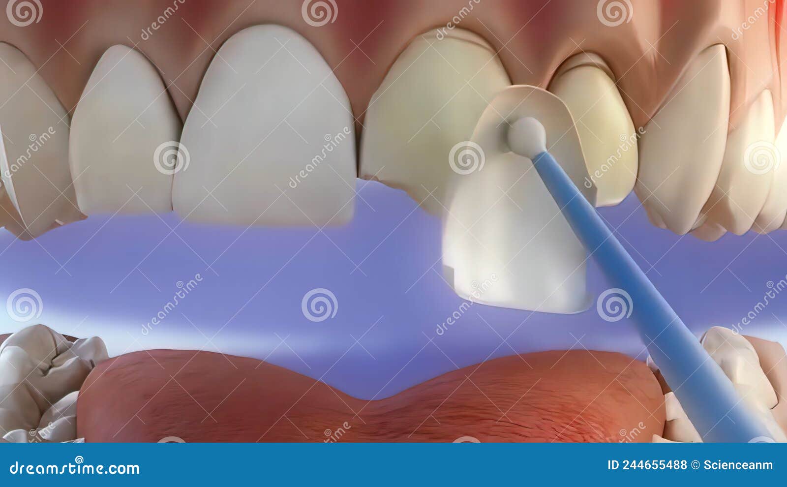 The Process of Chipping Damaged Teeth Stock Illustration - Illustration ...