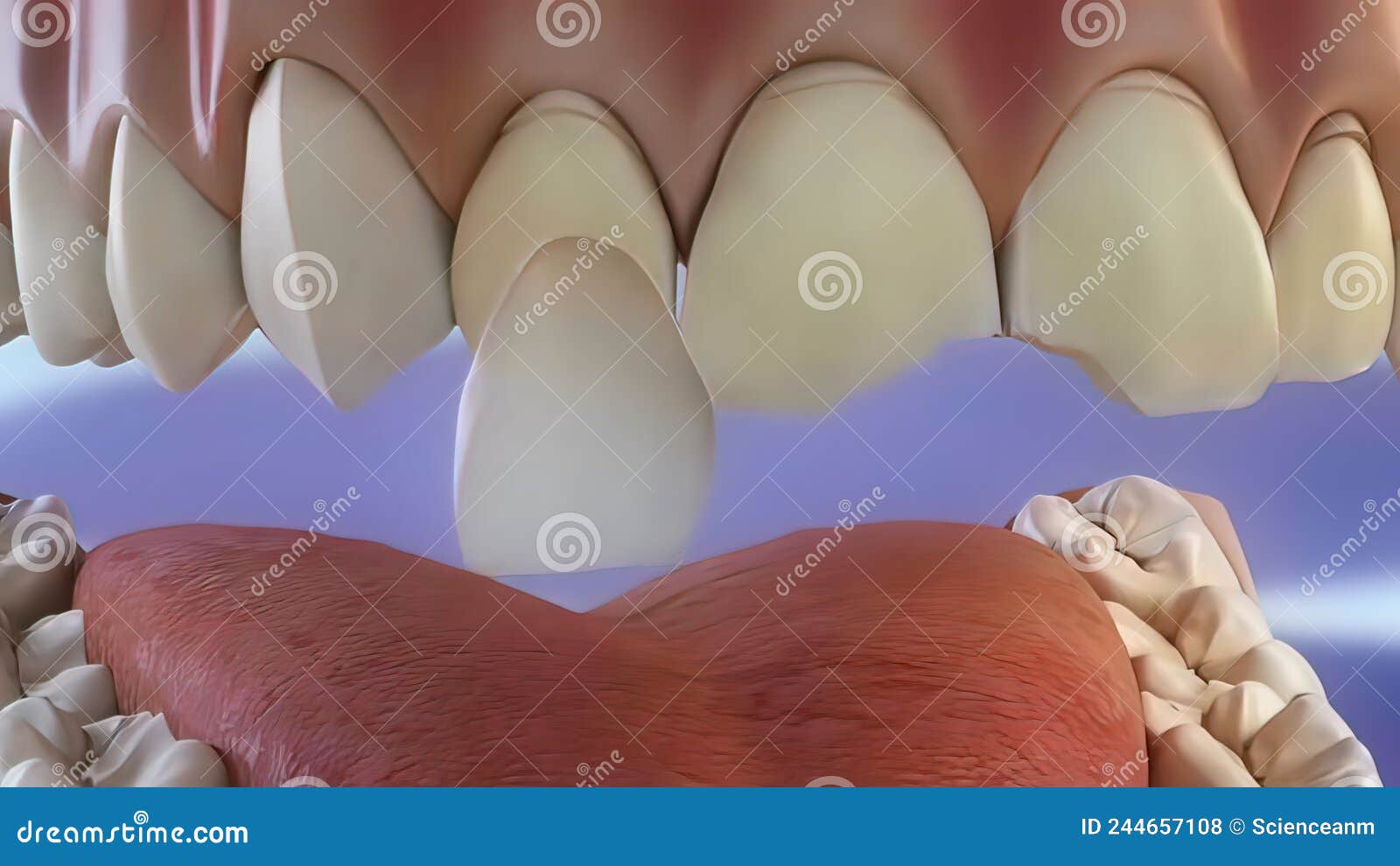 The Process of Chipping Damaged Teeth Stock Illustration - Illustration ...